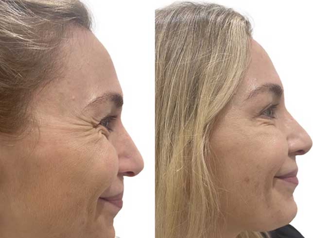 Anti-Wrinkle Botox - MedArt Clinic