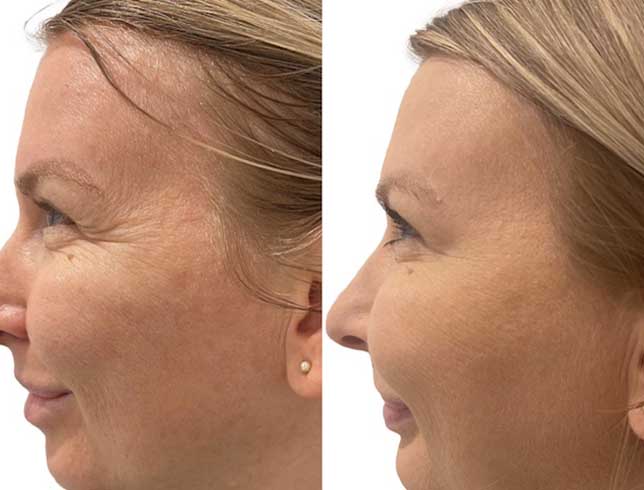 Anti-Wrinkle Botox - MedArt Clinic