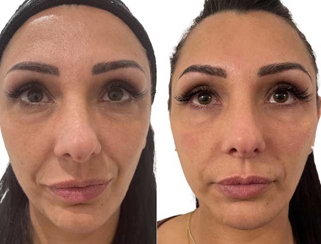 Full Face Rejuvenation / Beautification - MedArt Clinic