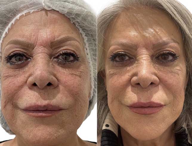 Full Face Rejuvenation / Beautification - MedArt Clinic