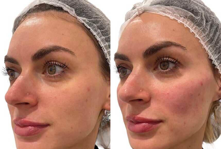 Cheek Filler - MedArt Clinic